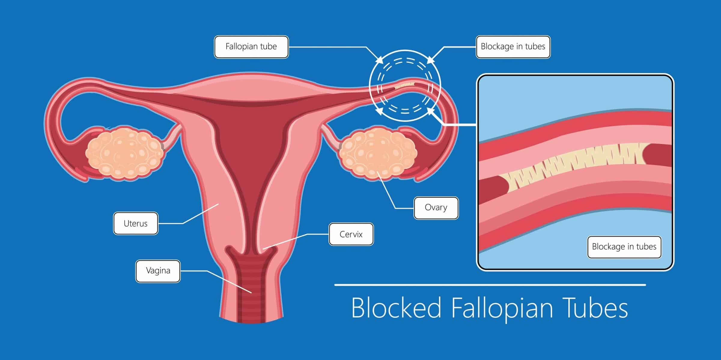The 7 Steps To Getting Pregnant With Blocked Fallopian Tubes